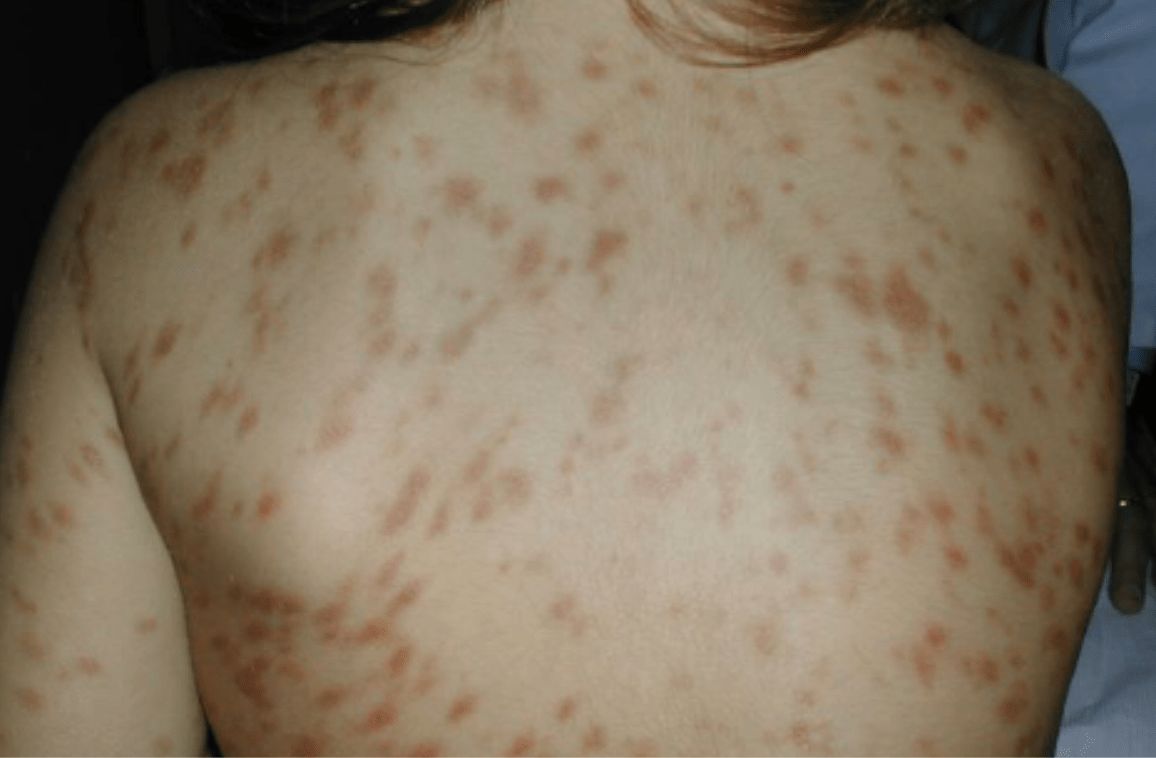Urticaria Pigmentosa Symptoms & Treatments Urticaria Pigmentosa Symptoms & Treatments